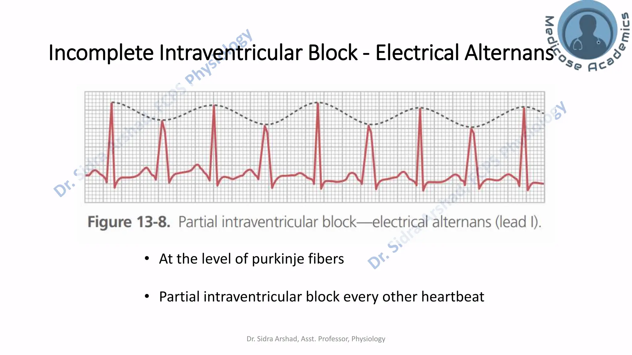 Interpretation of ECG - Cardiac Arrhythmias | PPTX