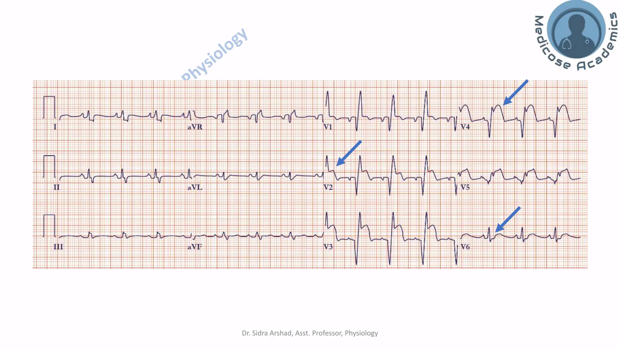 Interpretation of ECG - Cardiac Arrhythmias | PPTX