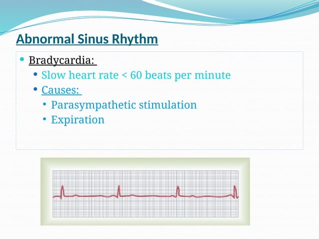 Cardiac Arrhythmias, Pathophysiology Lecture (Cardiology). pptx | PPTX