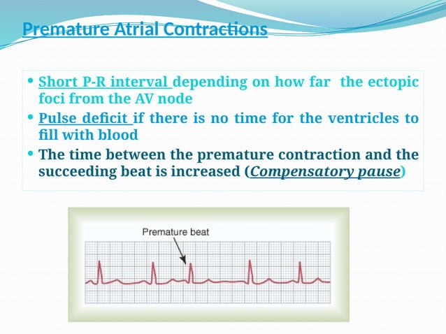 Cardiac Arrhythmias, Pathophysiology Lecture (Cardiology). pptx | PPTX