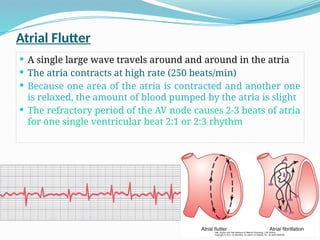 Cardiac Arrhythmias, Pathophysiology Lecture (Cardiology). pptx | PPTX