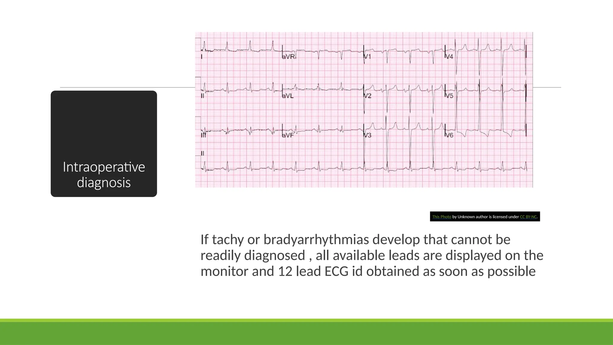 Arrhythmias vascular and hemorrhage (2) (1).pptx
