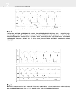 Cardiac arrhythmias and mapping techniques | PDF