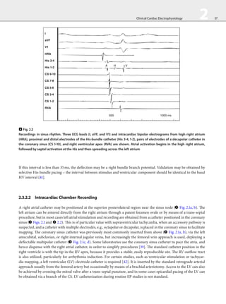 Cardiac arrhythmias and mapping techniques | PDF