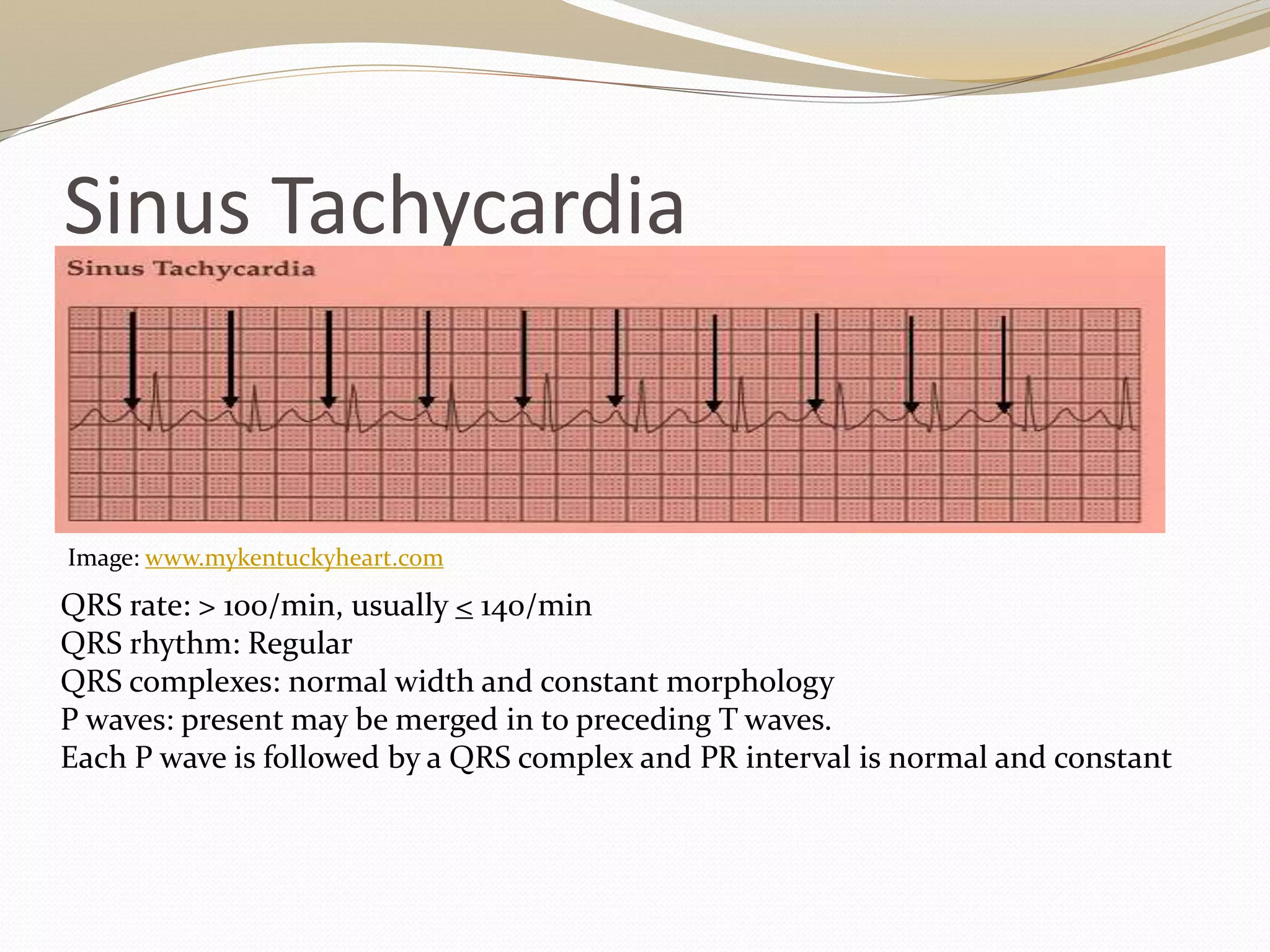 Cardiac arrhythmias originating in sinus node modified | PPTX