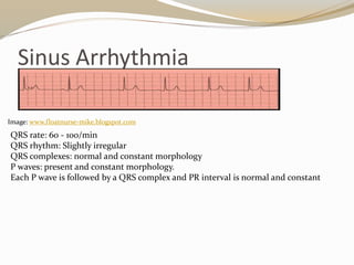 Cardiac arrhythmias originating in sinus node modified | PPTX | Heart ...