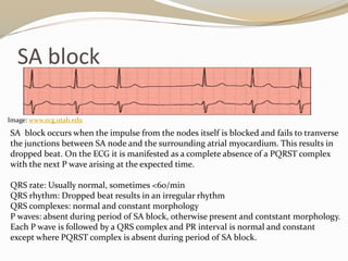 Cardiac arrhythmias originating in sinus node modified | PPTX | Heart ...