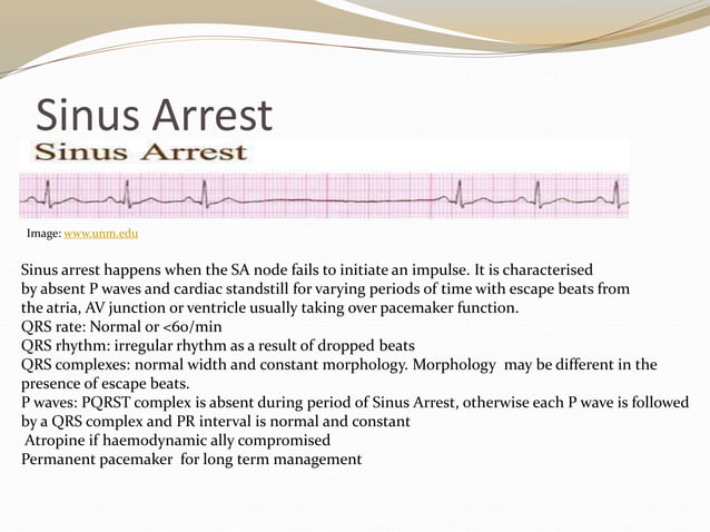 Cardiac arrhythmias originating in sinus node modified | PPTX | Heart ...