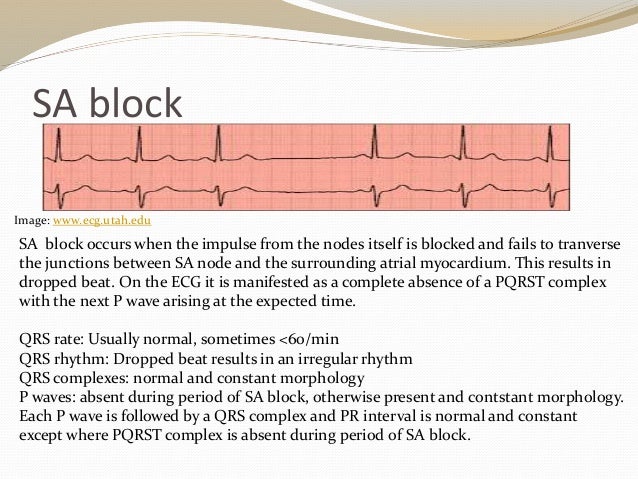 Cardiac arrhythmias originating in sinus node modified