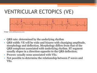 Cardiac arrhythmias originating in the ventricles | PPTX