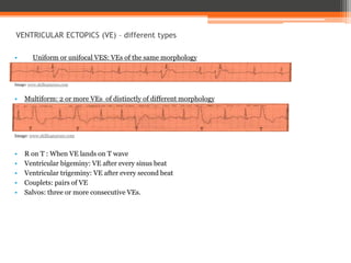 Cardiac arrhythmias originating in the ventricles | PPTX