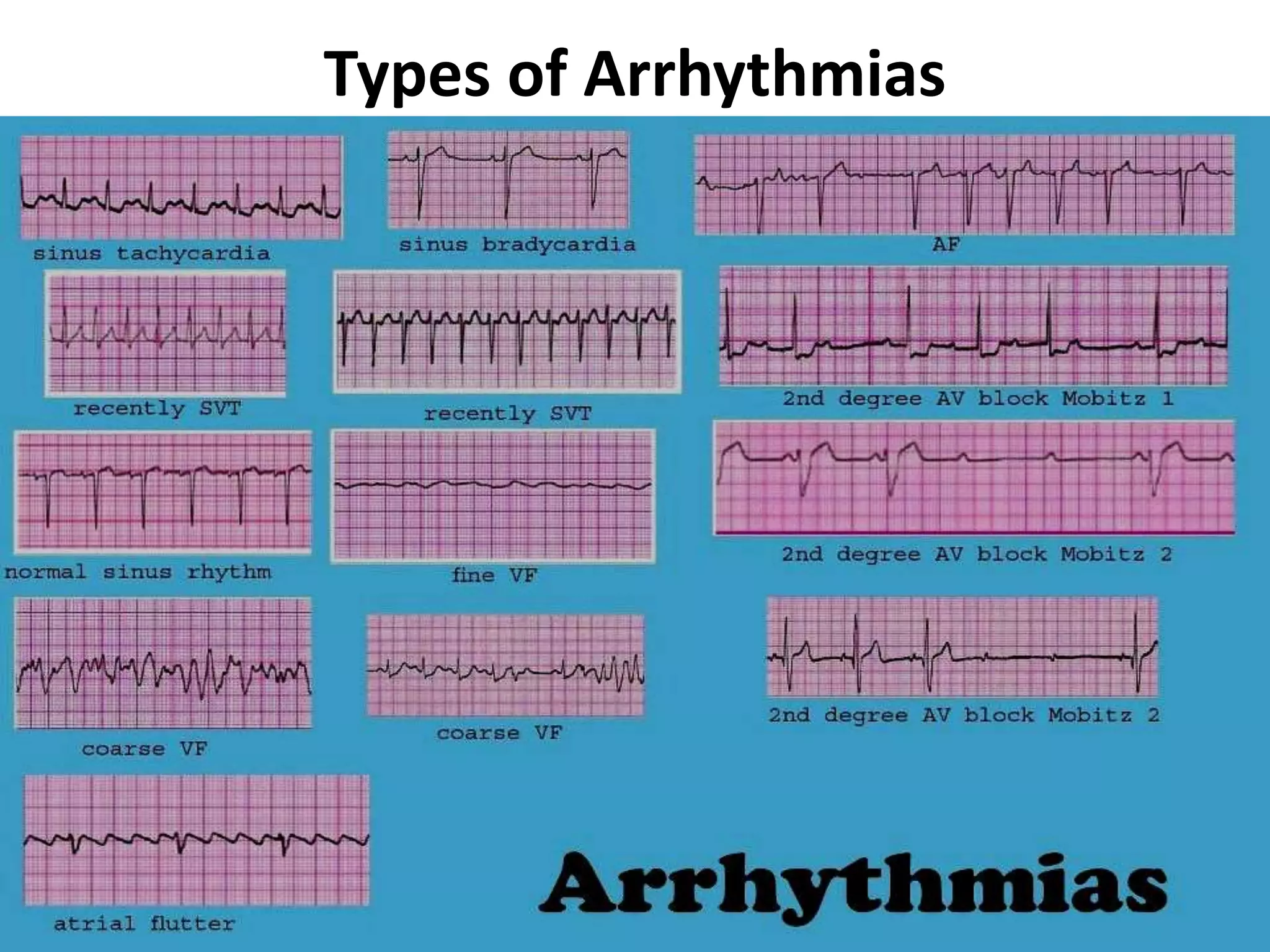 Cardiac arrhythmias--- pharmacotherapeutics-I | PPTX
