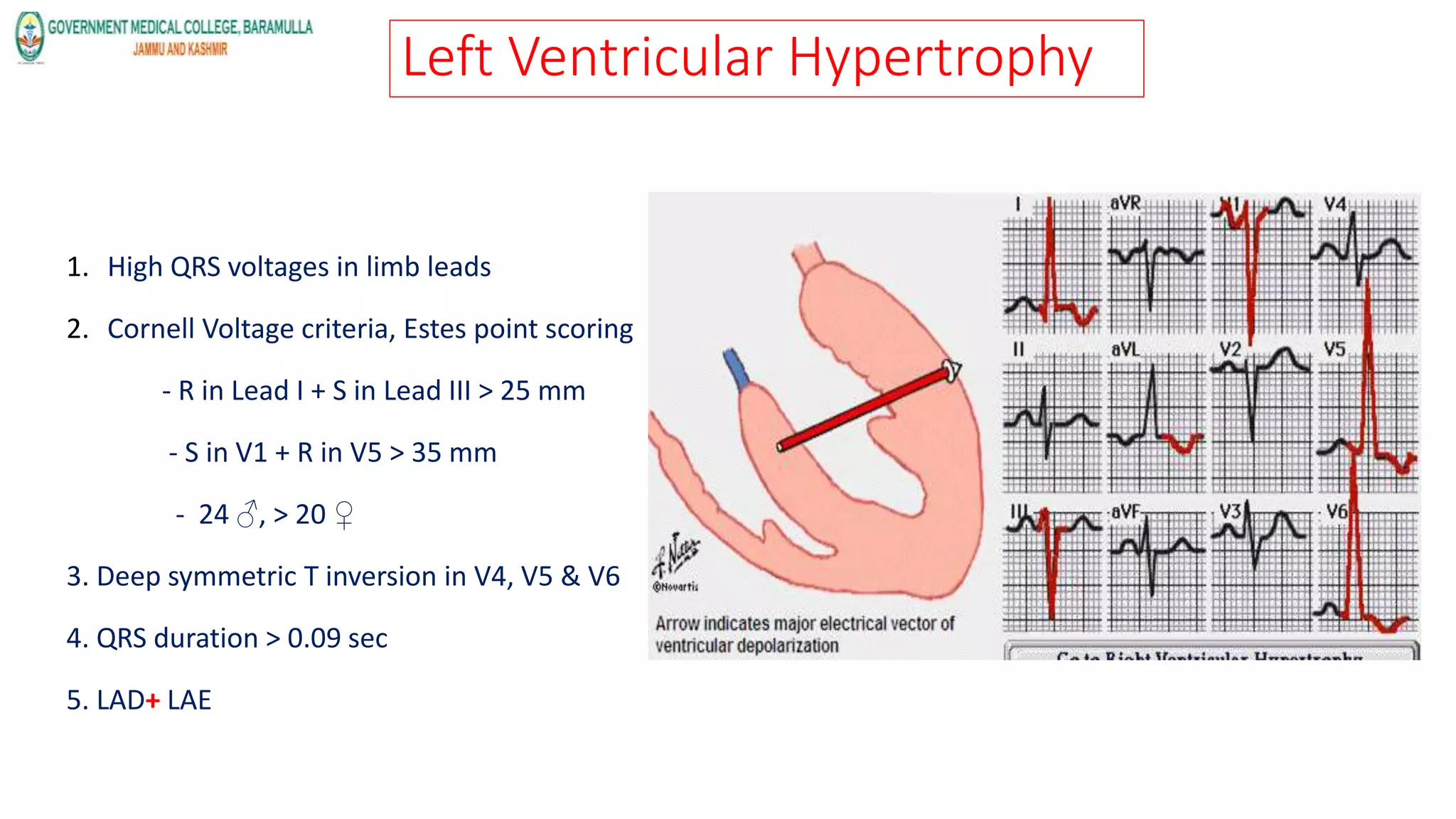 CARDIAC ARRTHYMIAs PART 2 BY DR. QAZI IMTIAZ RASOOL | PPT