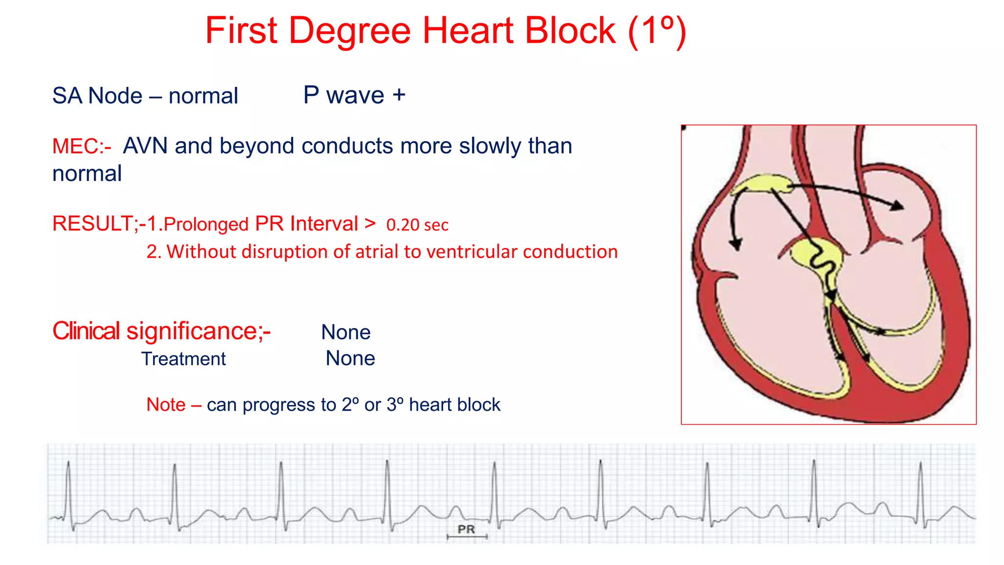 CARDIAC ARRTHYMIAs PART 2 BY DR. QAZI IMTIAZ RASOOL | PPT