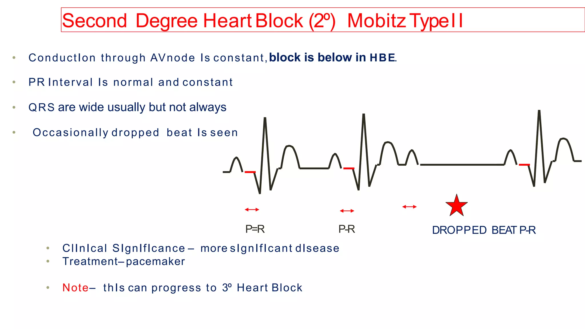CARDIAC ARRTHYMIAs PART 2 BY DR. QAZI IMTIAZ RASOOL | PPT