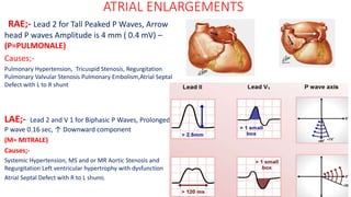 CARDIAC ARRTHYMIAs PART 2 BY DR. QAZI IMTIAZ RASOOL | PPT