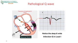 CARDIAC ARRTHYMIAs PART 2 BY DR. QAZI IMTIAZ RASOOL | PPT