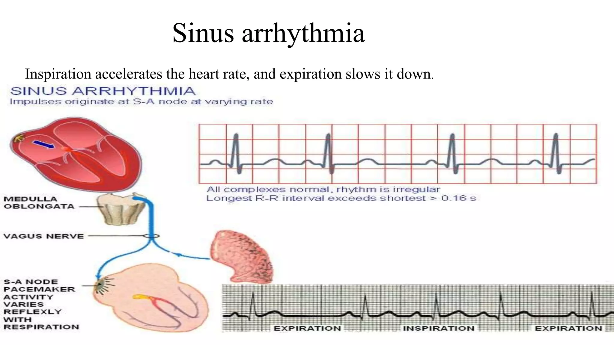 CARDIAC ARRYTHMIA AND ITS MANAGEMENT.pptx