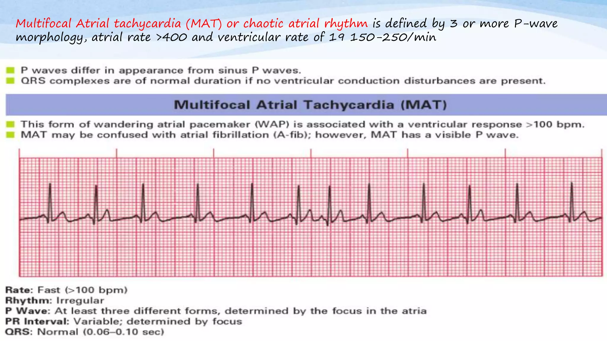 Cardiac arrythmia in children | PPTX