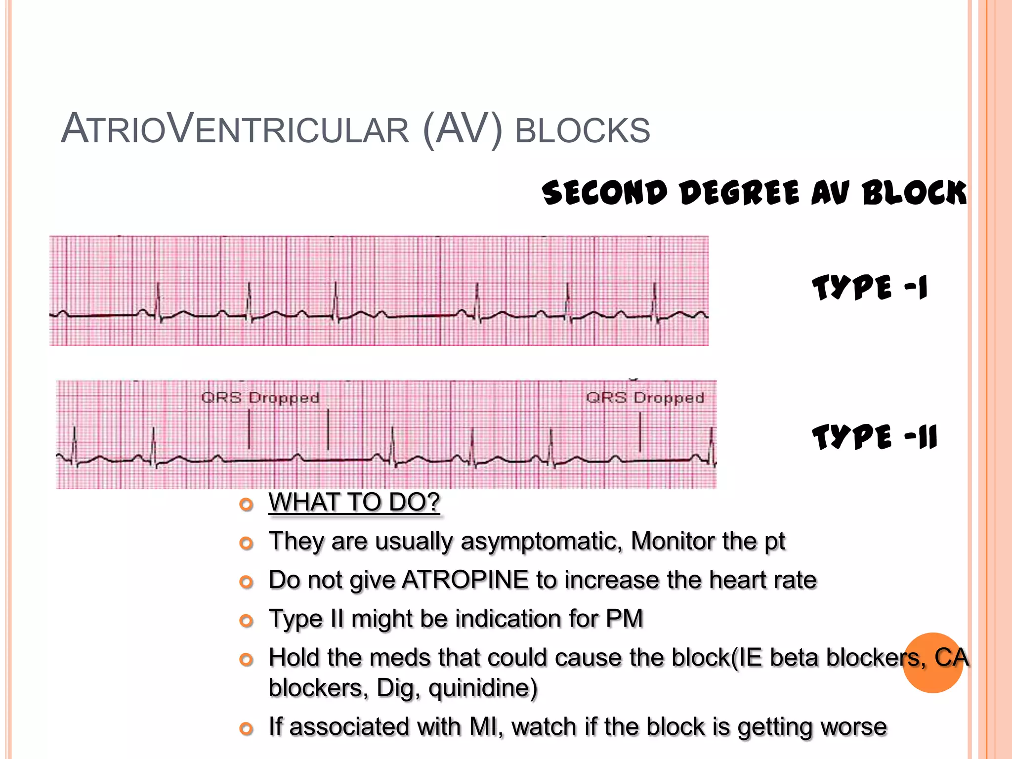 Cardiac arrythmias | PPTX