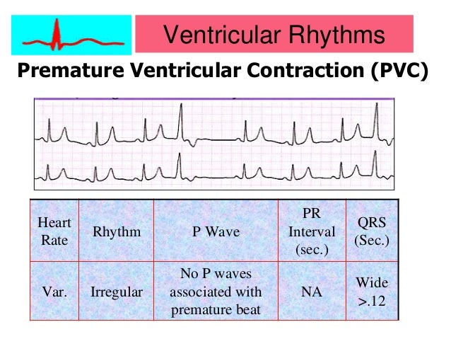 Cardiac arrythmias