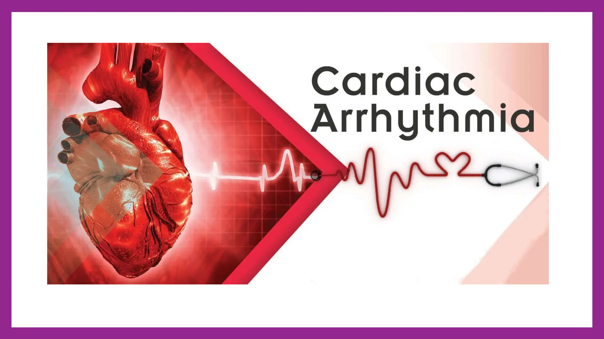 cardiac arrythmias .my presentation (1) - Copy.pptx