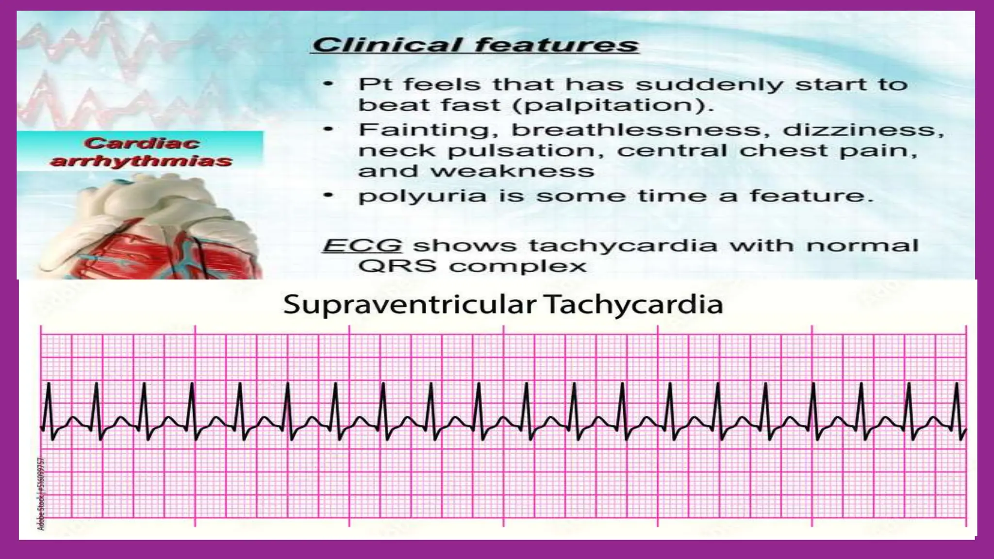 cardiac arrythmias .my presentation (1) - Copy.pptx