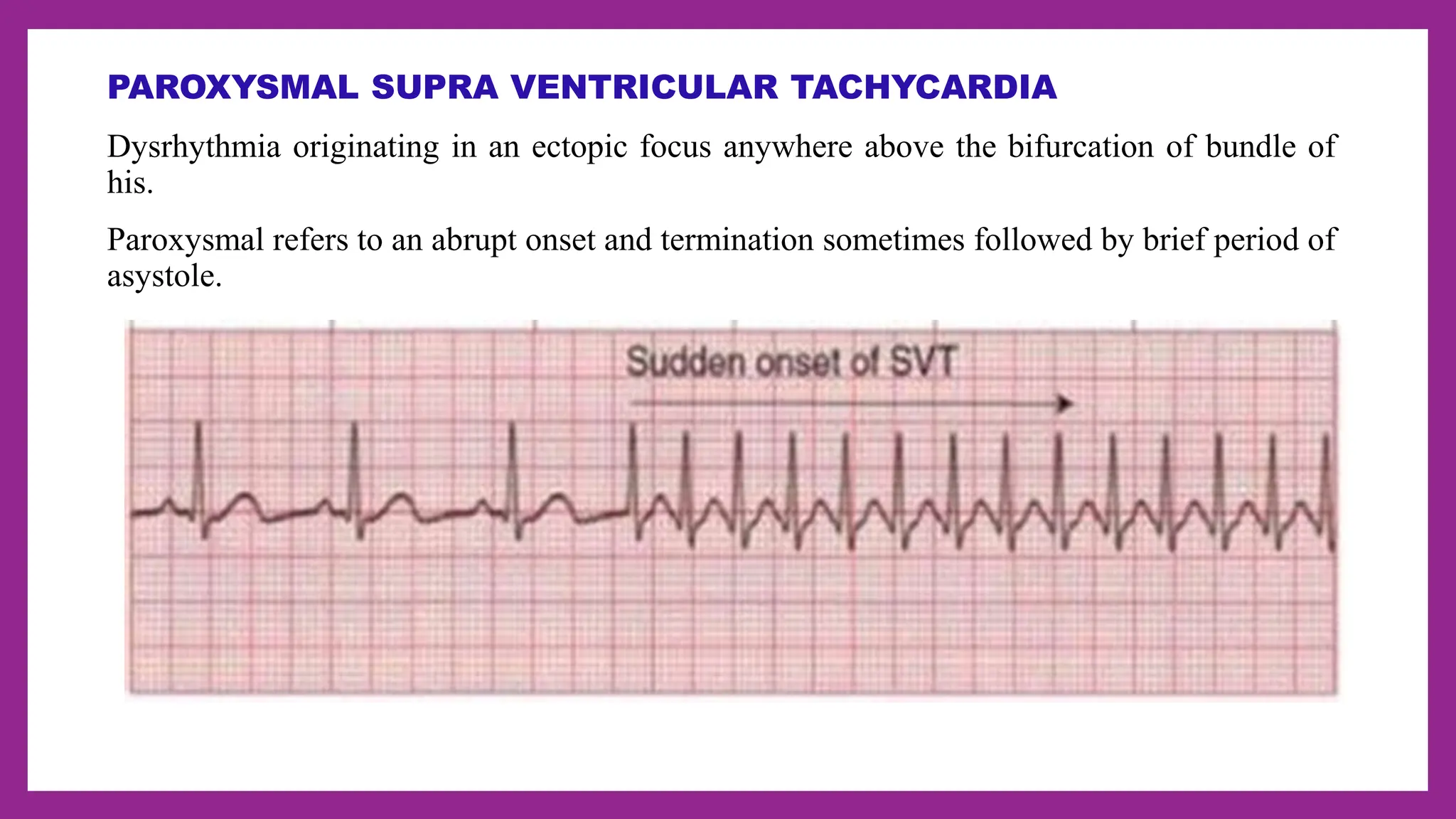 cardiac arrythmias .my presentation (1) - Copy.pptx