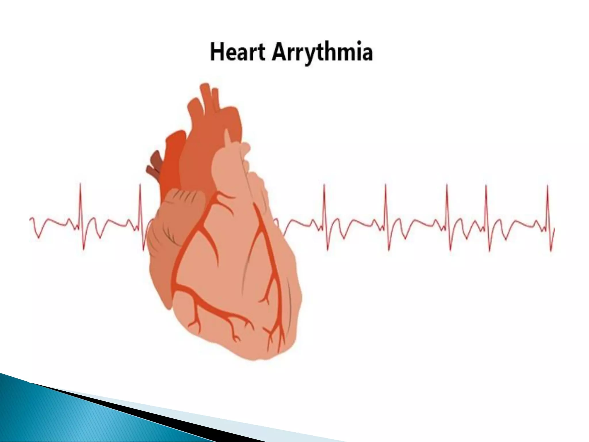 Cardiac Arrhythmia | PDF