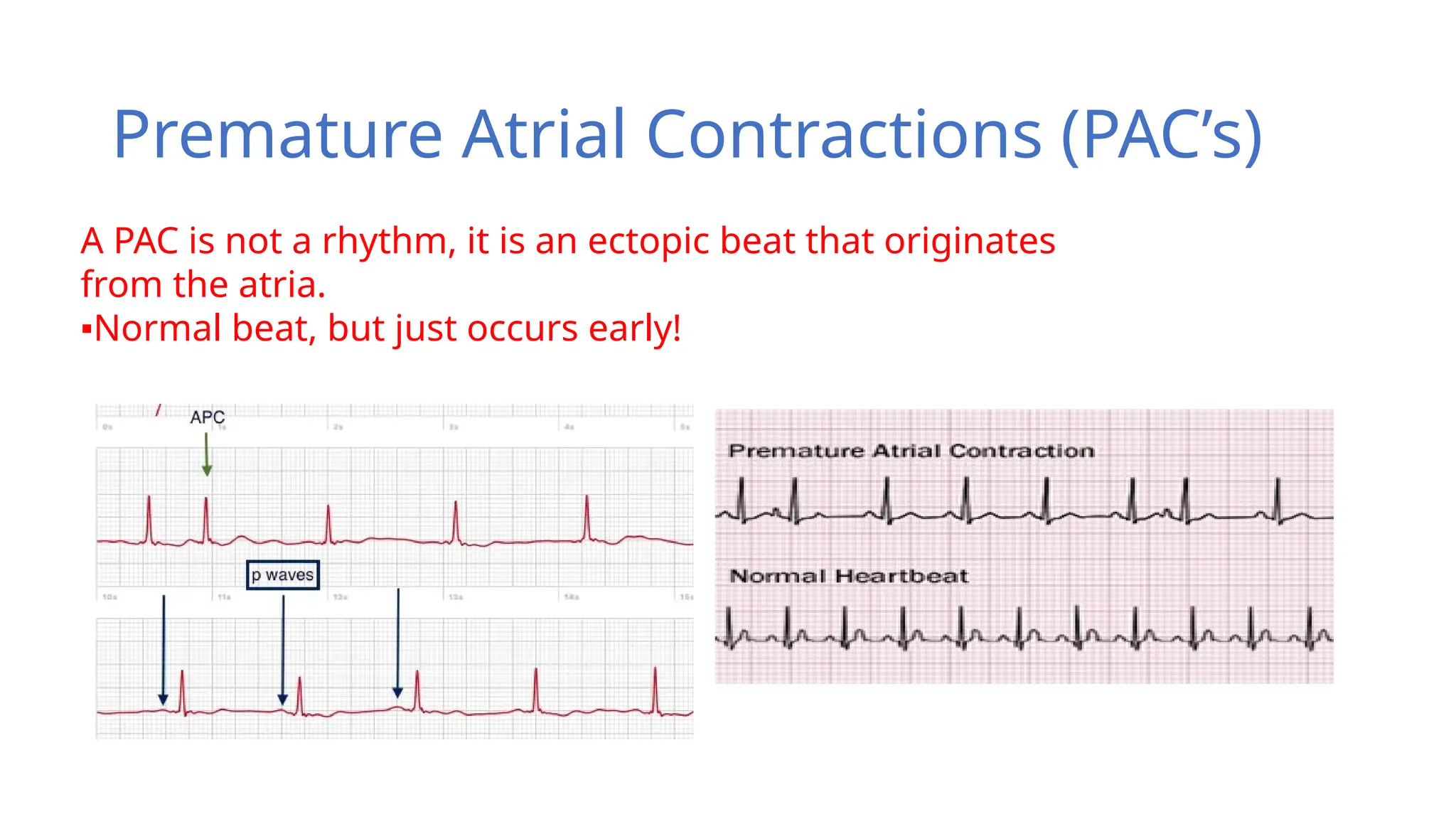cardiac Arrythmias1 topic for emergency nursing student AAUP .pptx