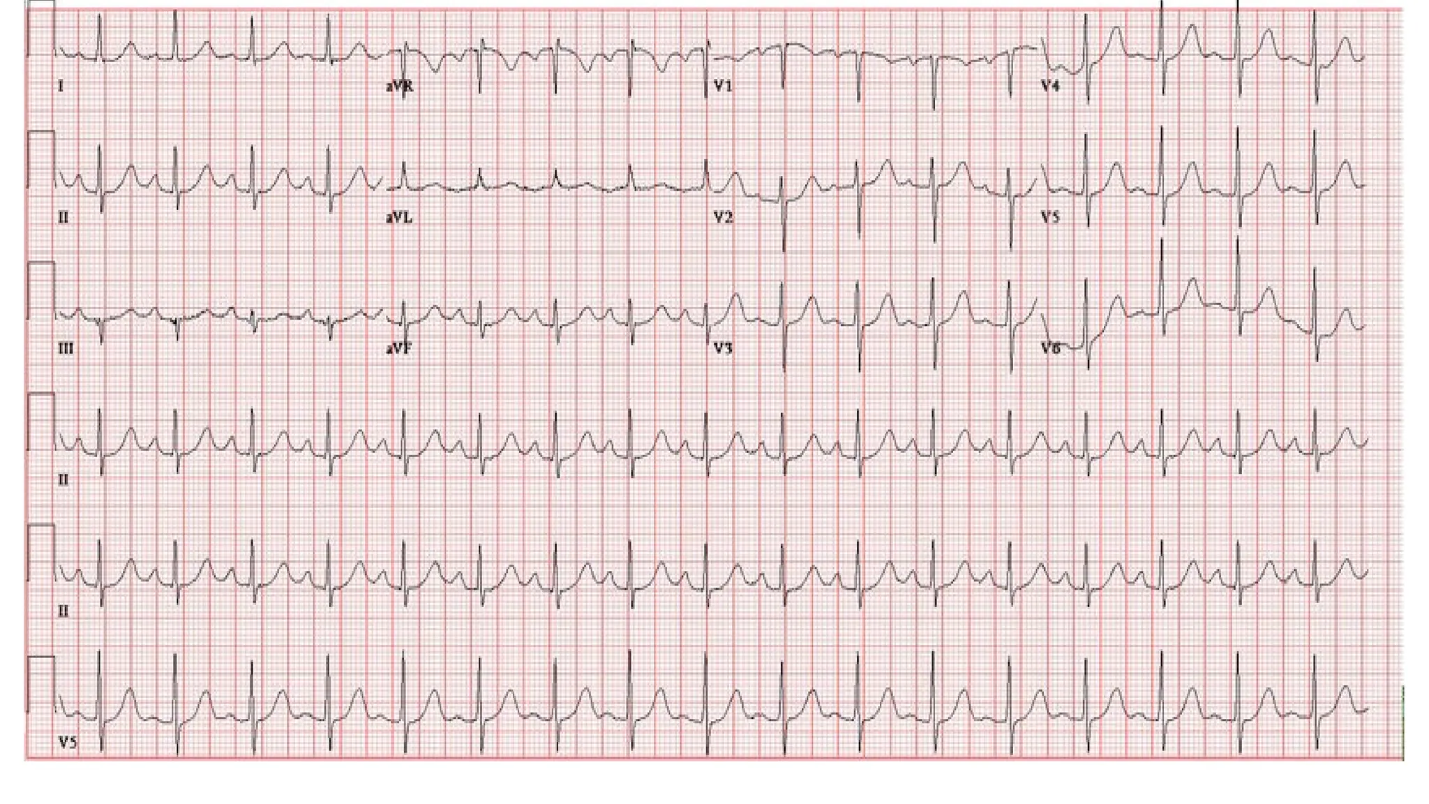 cardiac Arrythmias1 topic for emergency nursing student AAUP .pptx