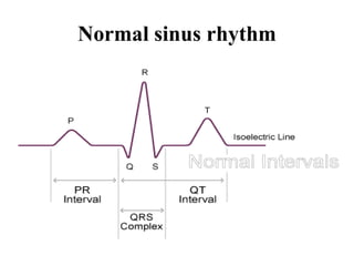 Cardiac arrythmias iml | PPT