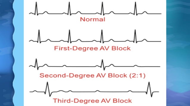Cardiac Arrhythmias | PPT