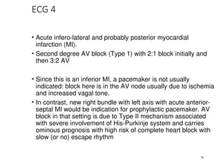 Cardiac Arrythmias Tanisha Baladia Internal Medicine.ppt