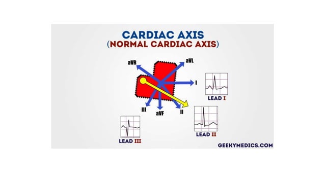 Cardiac axis | PPTX | Heart and Cardiovascular Diseases | Diseases and ...