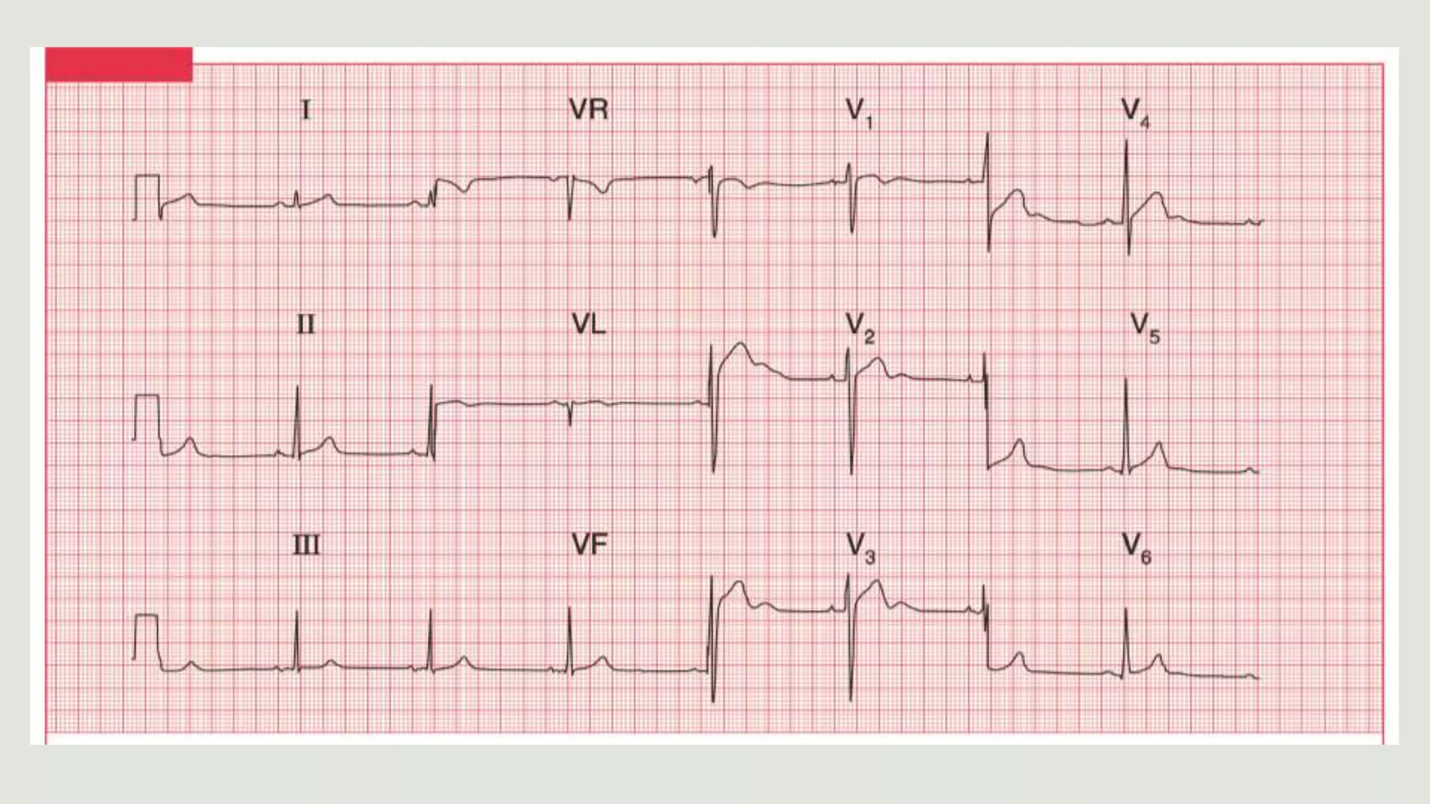 Cardiac Axis Simplified.pptx