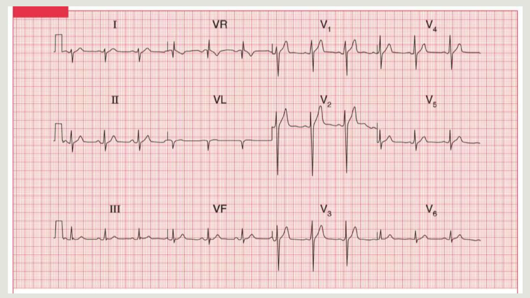 Cardiac Axis Simplified.pptx
