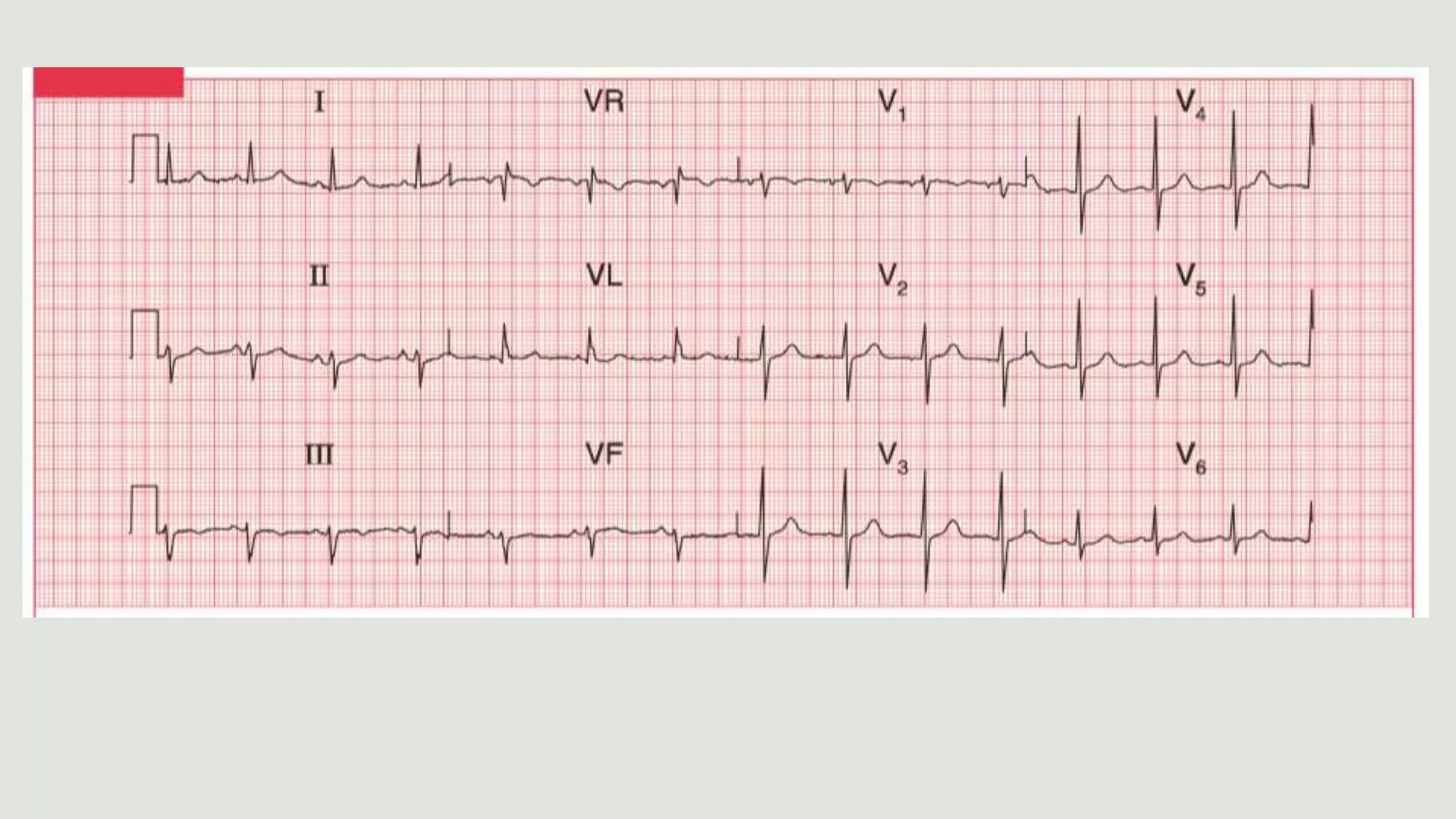 Cardiac Axis Simplified.pptx