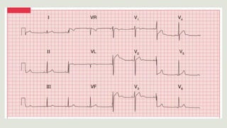 Cardiac Axis Simplified.pptx