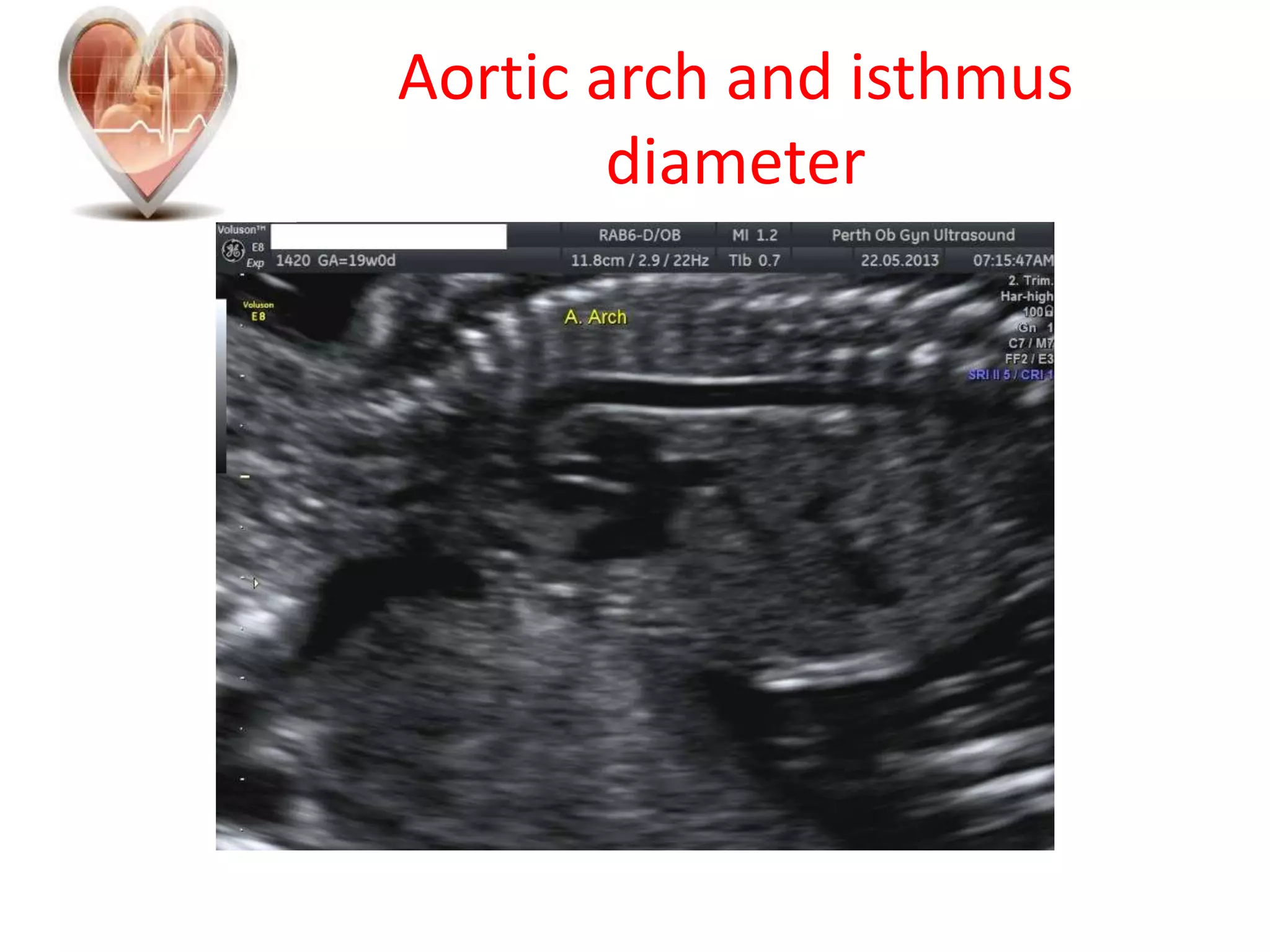 Cardiac biometry | PPTX