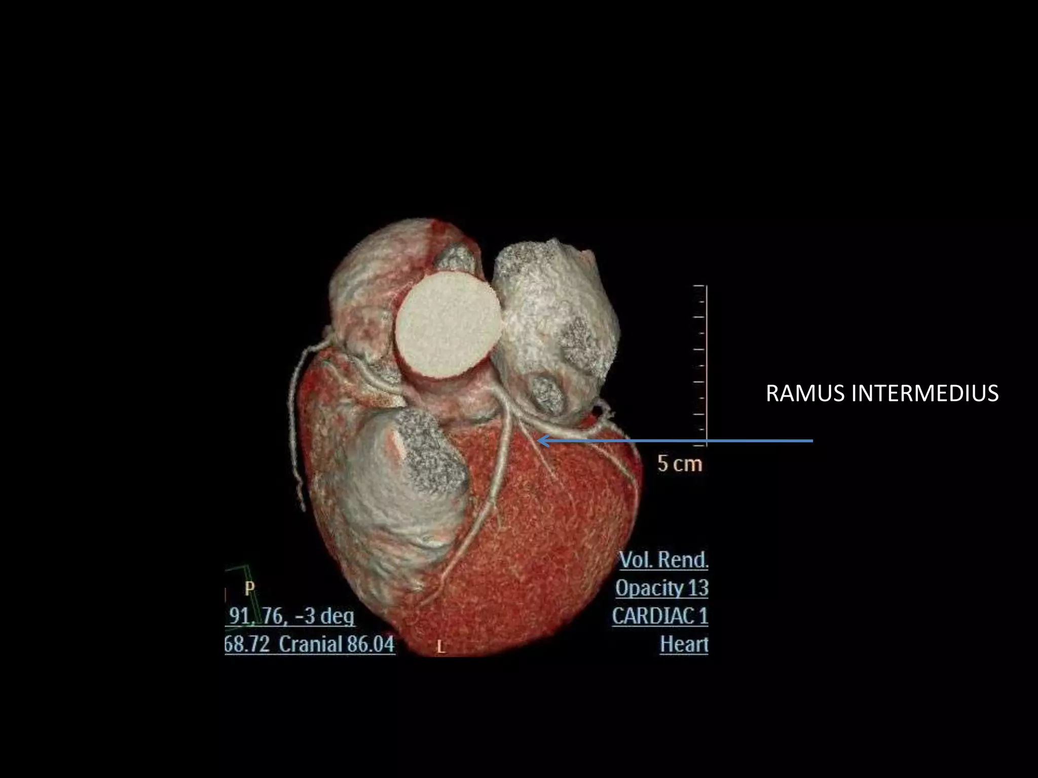 Cardiac case series ramus intermedius | PPTX