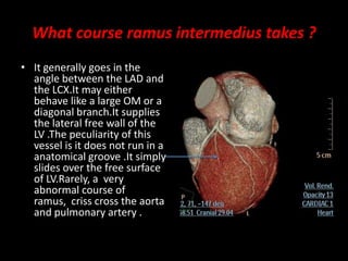 Cardiac case series ramus intermedius | PPTX