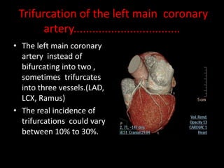Coronary Artery Anatomy Ramus