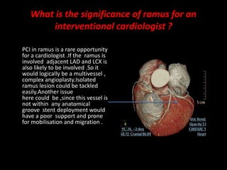 Coronary Artery Anatomy Ramus