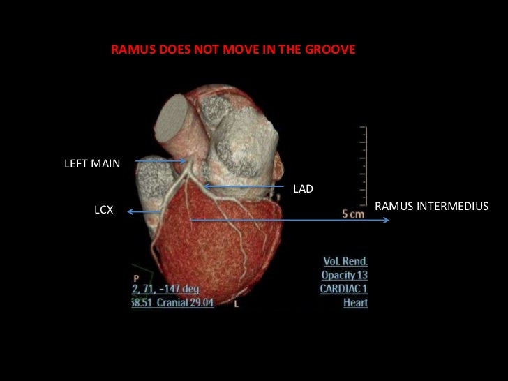 Cardiac case series ramus intermedius