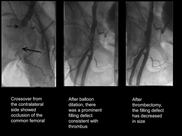 Cardiac cath complications | PPT