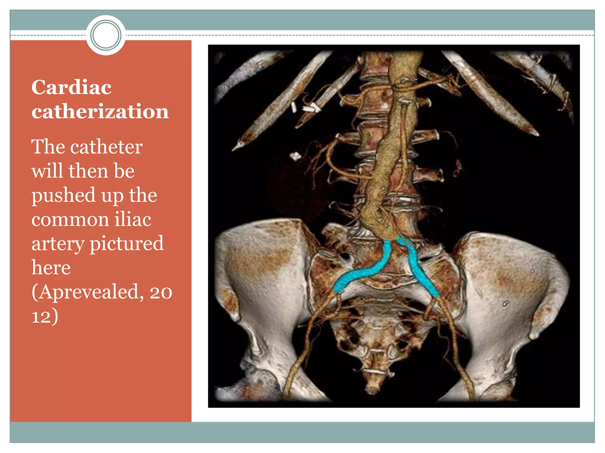 Cardiac Catherization Ip 2 | PPT