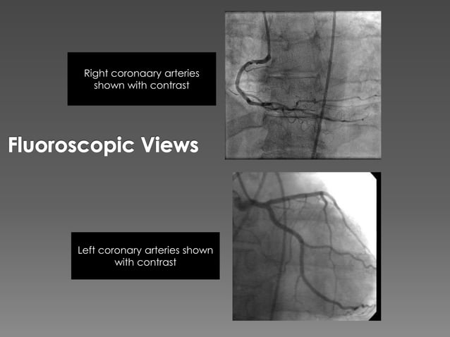 Cardiac catheterization | PPT