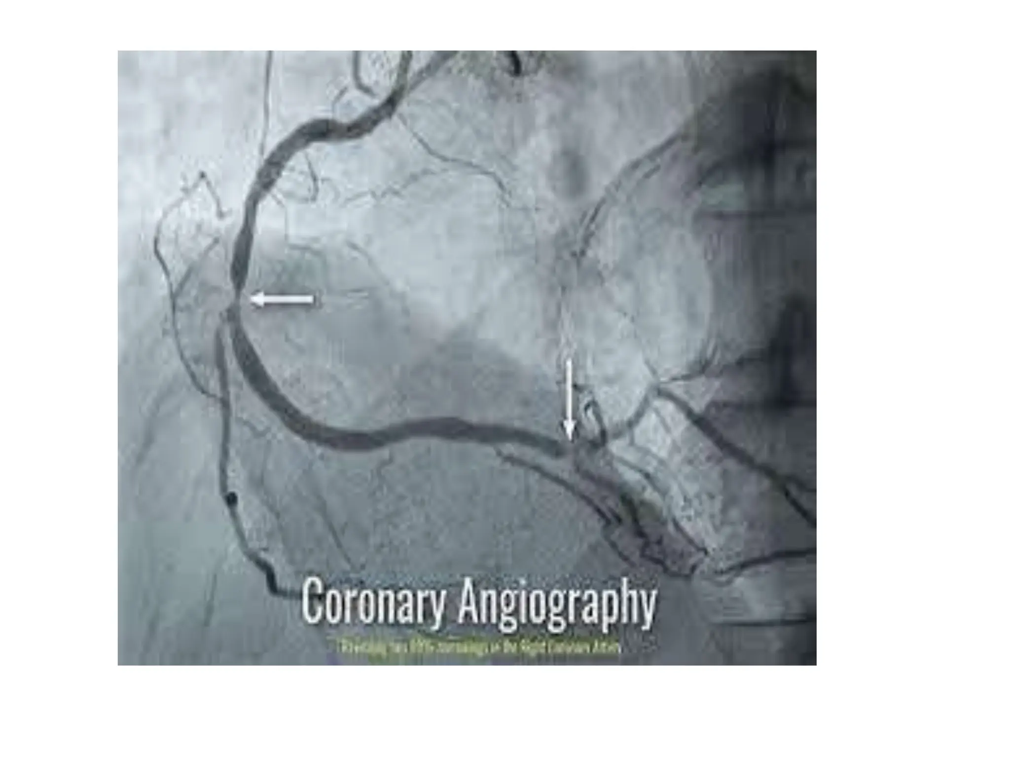 cardiac catheterization and coronary angiography (1).pptx