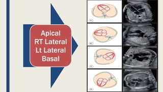 Cardiac chamber asmfm 2019 | PPT